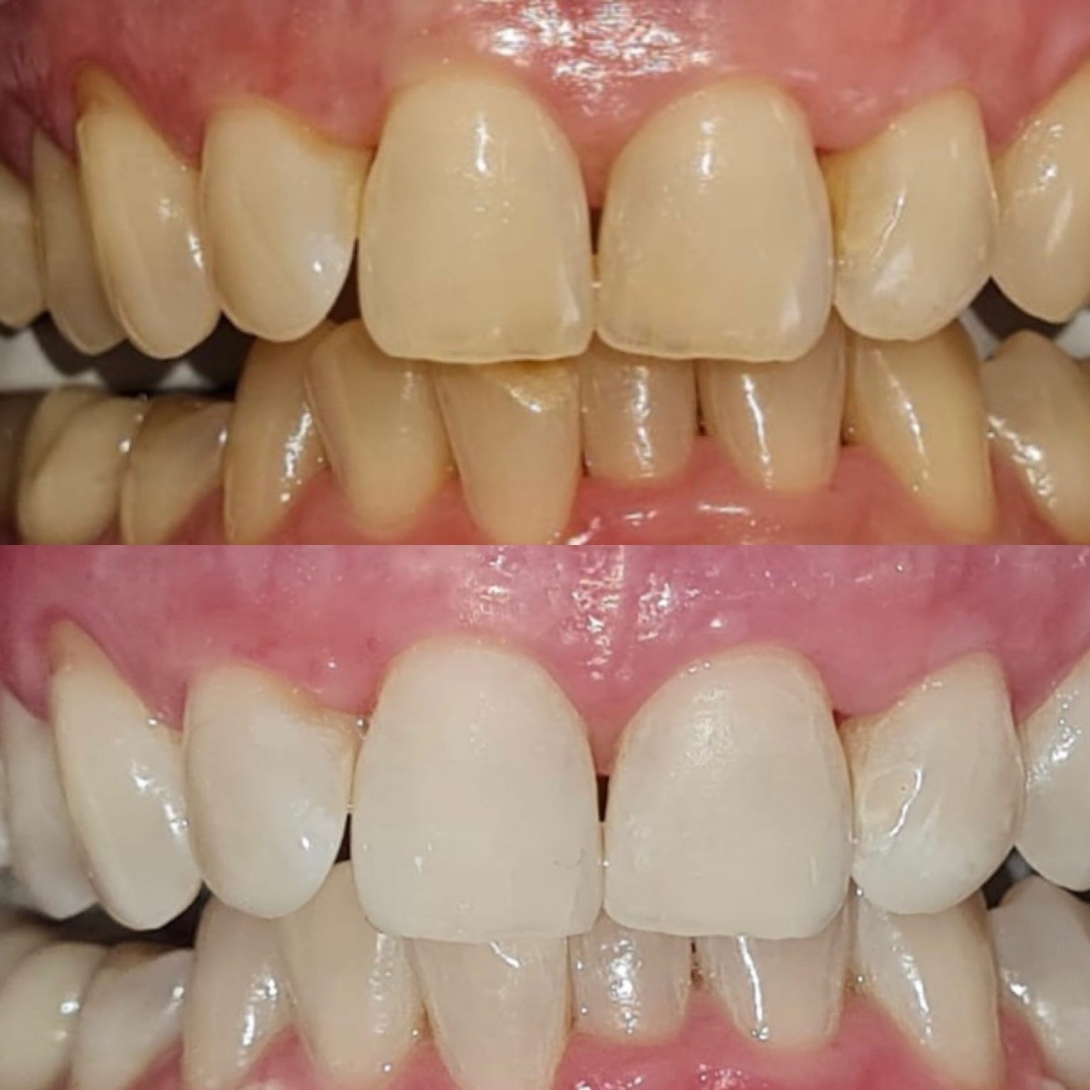 Bleaching – Ihr Zahnarzt in Ruppichteroth Schönenberg